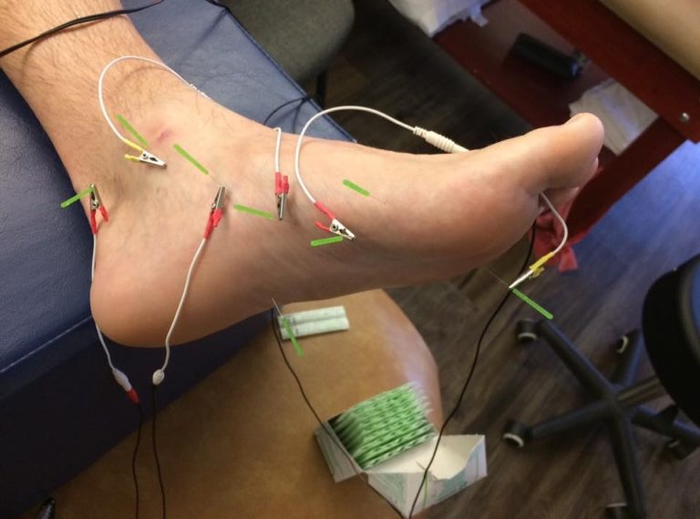 What is Dry Needling and how can it help? - Total Sports Therapy